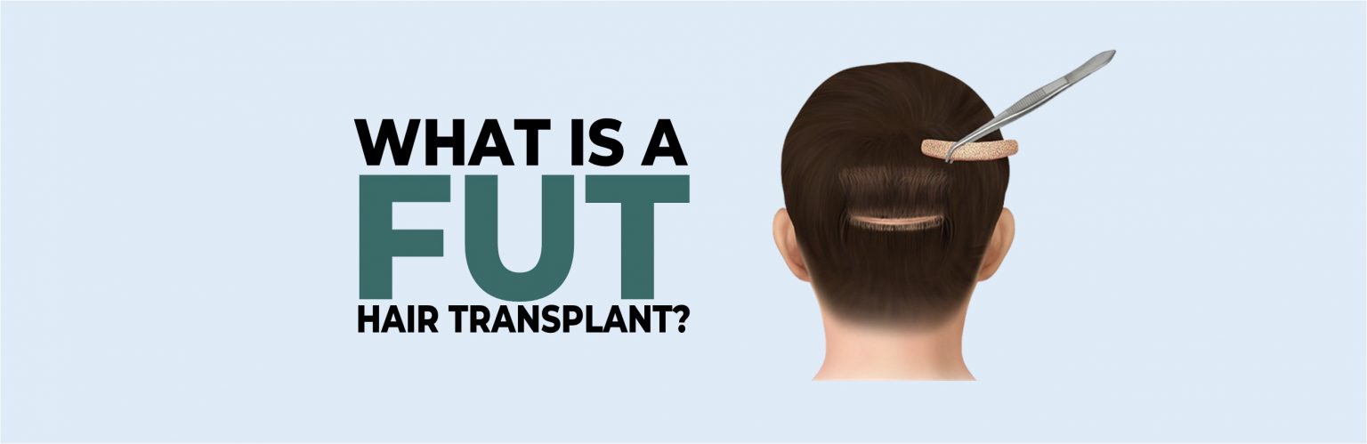What is a FUT Hair Transplant? | Hair Transplants in Canada