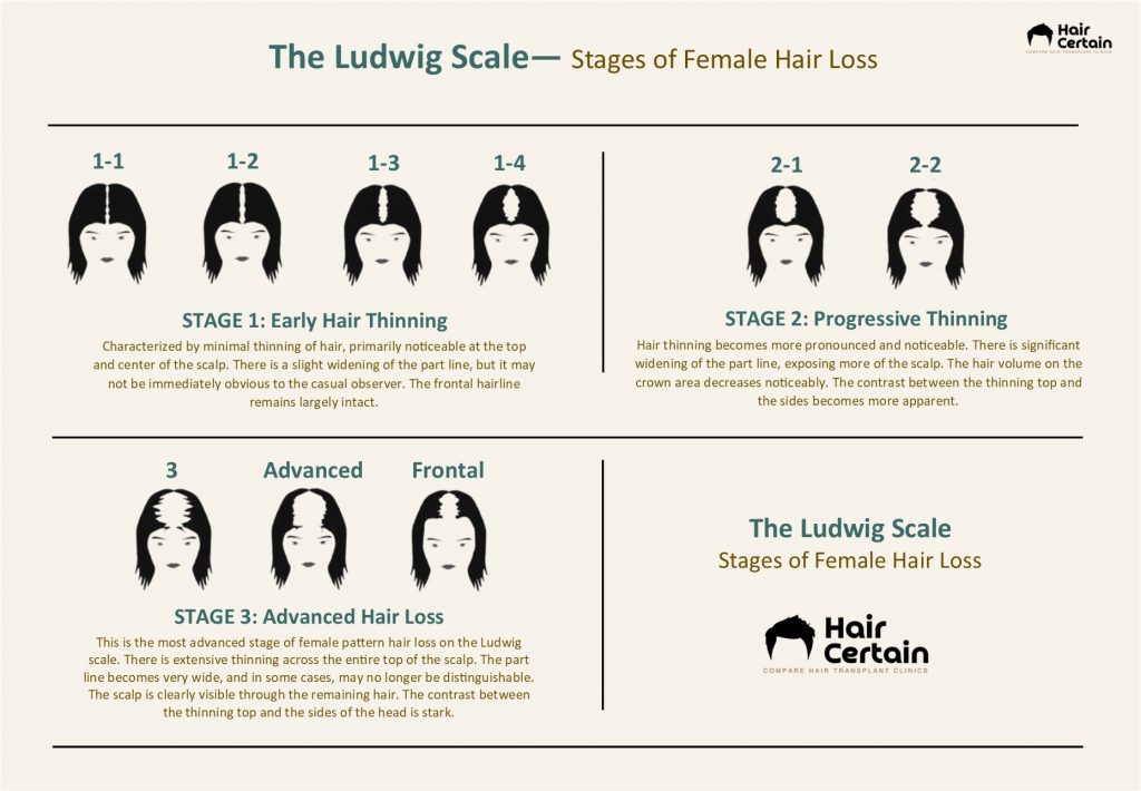 Ultimate Guide to Hair Transplant costs in Canada – Hair Transplants in ...